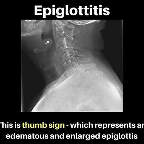 Epiglottitis Thumb Sign