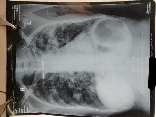 Radiographic findings in Pulmonary tuberculosis