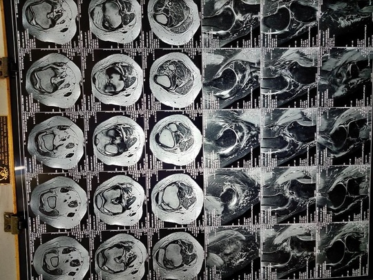 Proximal tibia fracture, treated with Pop