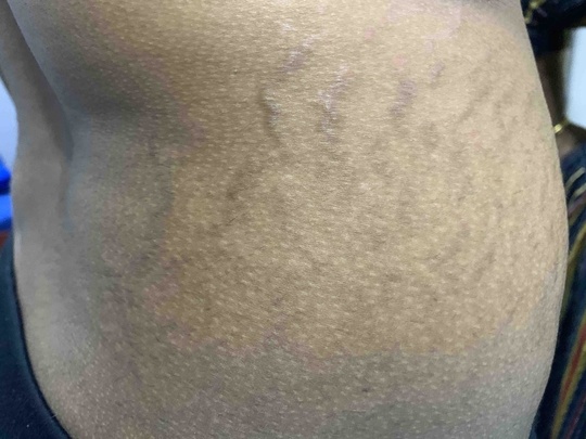 Engorged venous lesion on skin