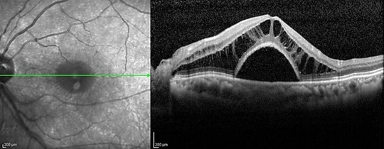Distorted vision and decreased visual acuity