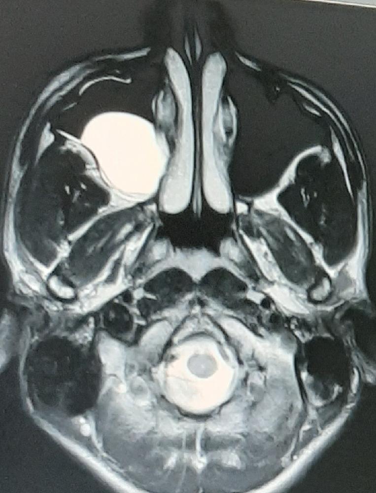 Maxillary Sinus Cyst MRI