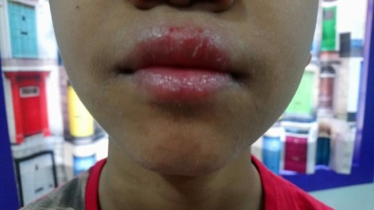Lupus Swollen Lips | Lipstutorial.org
