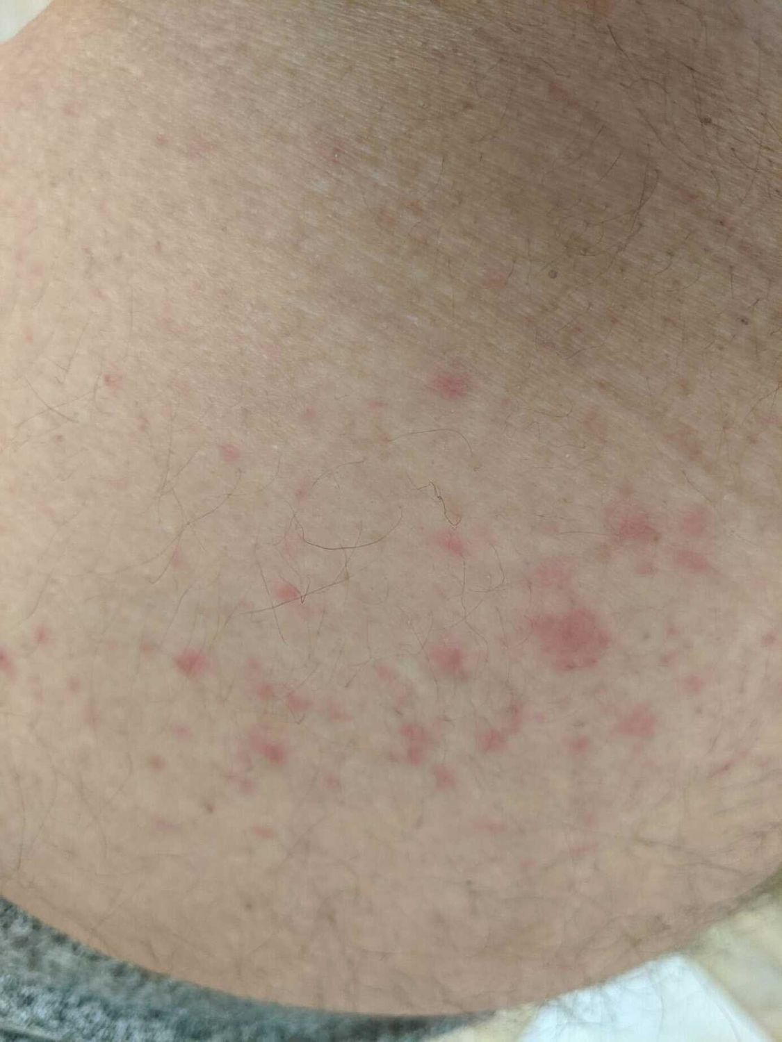 What is it? Allergy or Mosquito borne illness?