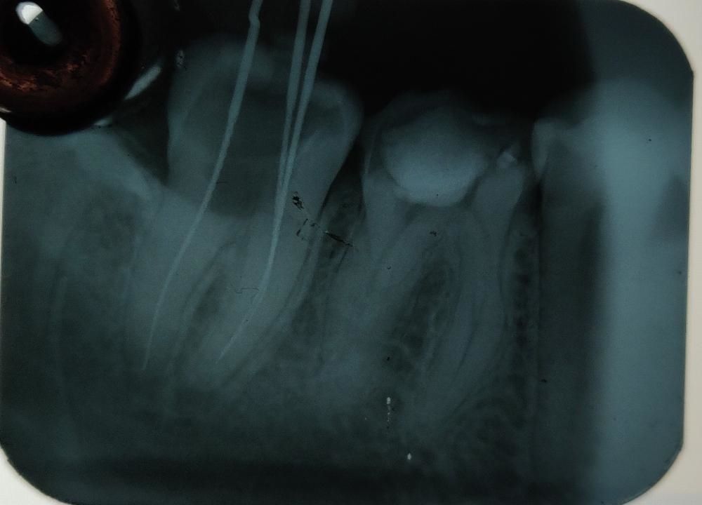 How to Repair endodontic Perforation
