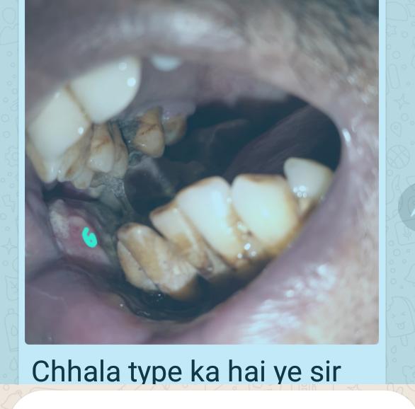 Ulcerative/pustular abcess/growth at gums