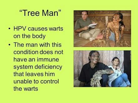 TREEMAN DISEASE