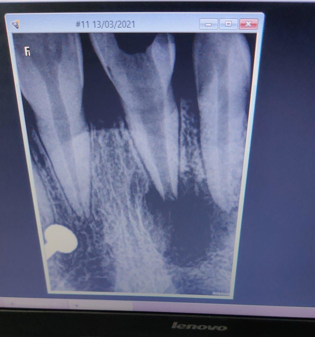 Periapical Abscess Radiograph