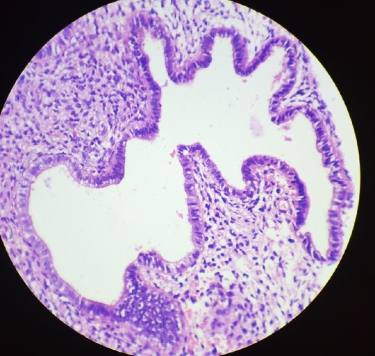 HISTOPATHOLOGY BIOPSY