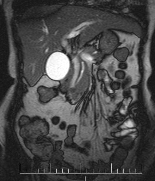 ? Choledocholithiasis