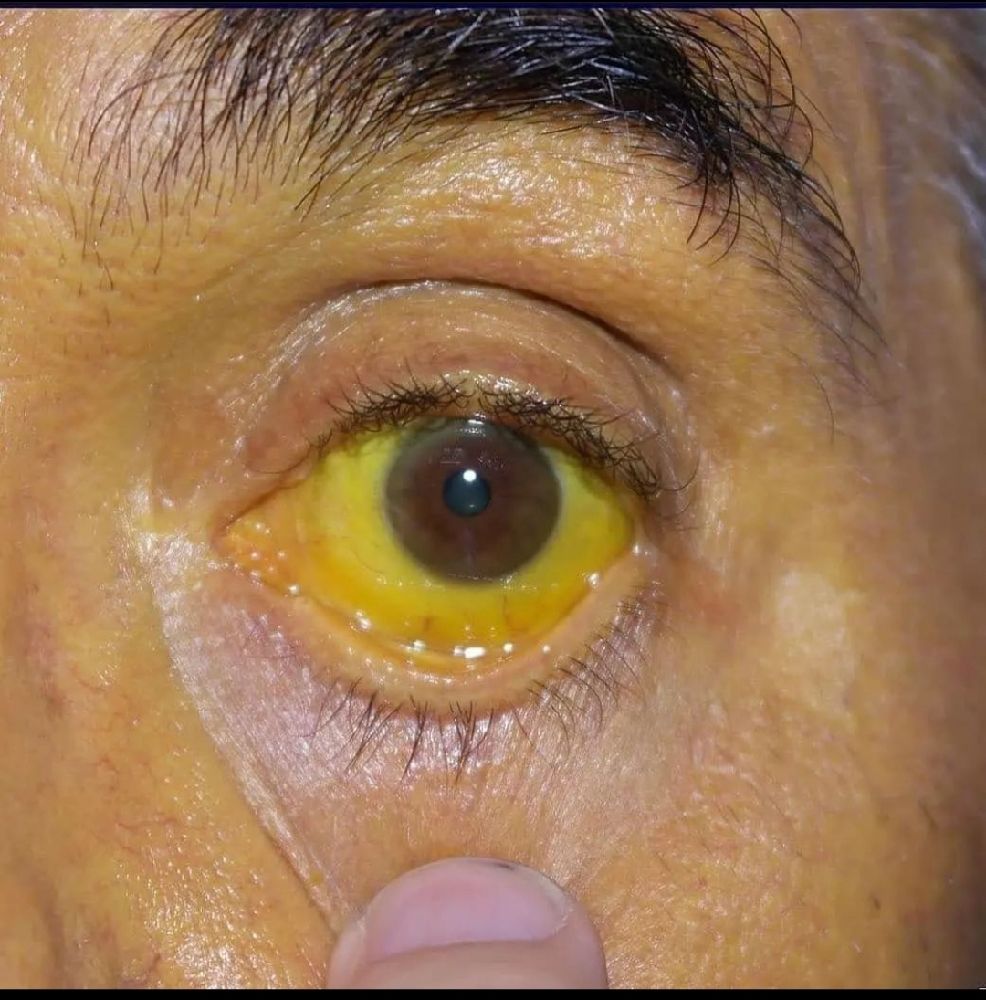 RIGHT UPPER QUADRANT ( RUQ ).