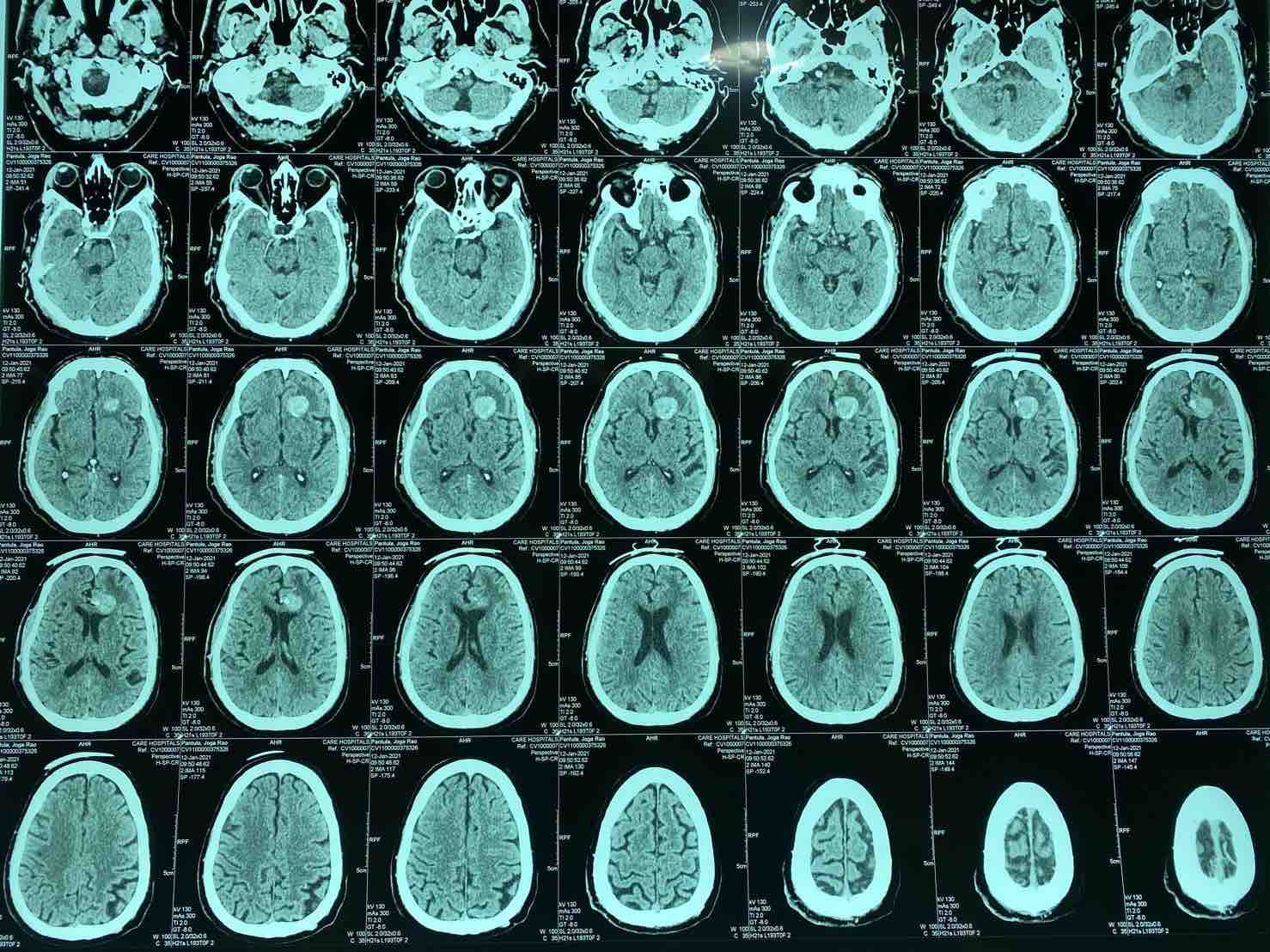 Rare Aortic Dissection using POCUS in ER Department