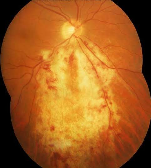 Cmv Retinitis Mri