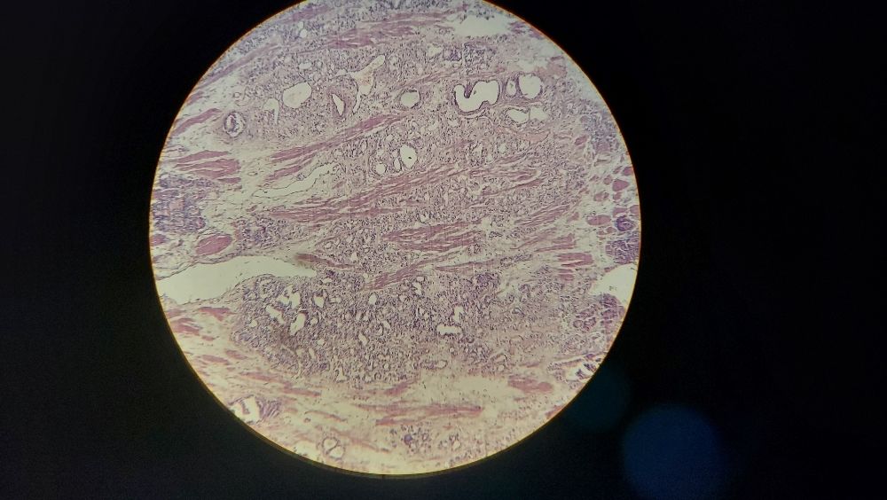 TURP