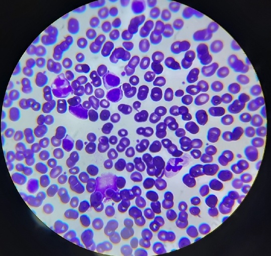 PERIPHERAL SMEAR EXAMINATION