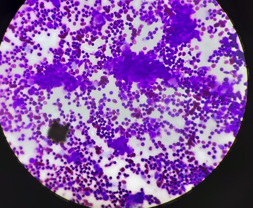 PLEURAL FLUID ANALYSIS