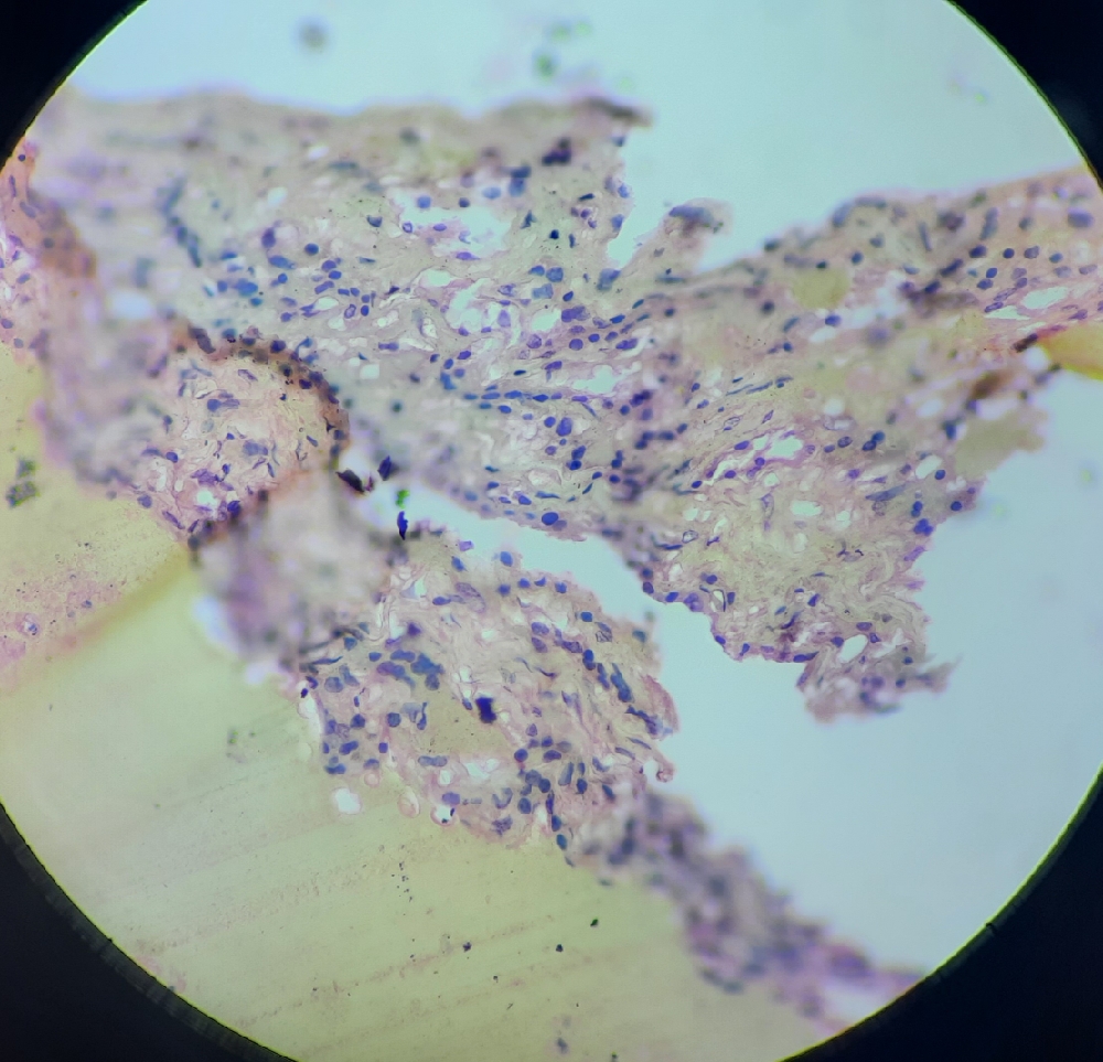 Ovarian Mass Biopsy