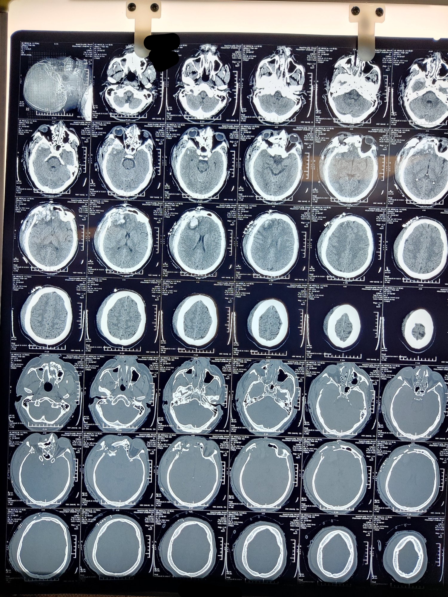 POLYTRAUMA WITH SEVERE TRAUMATIC BRAIN INJURY.