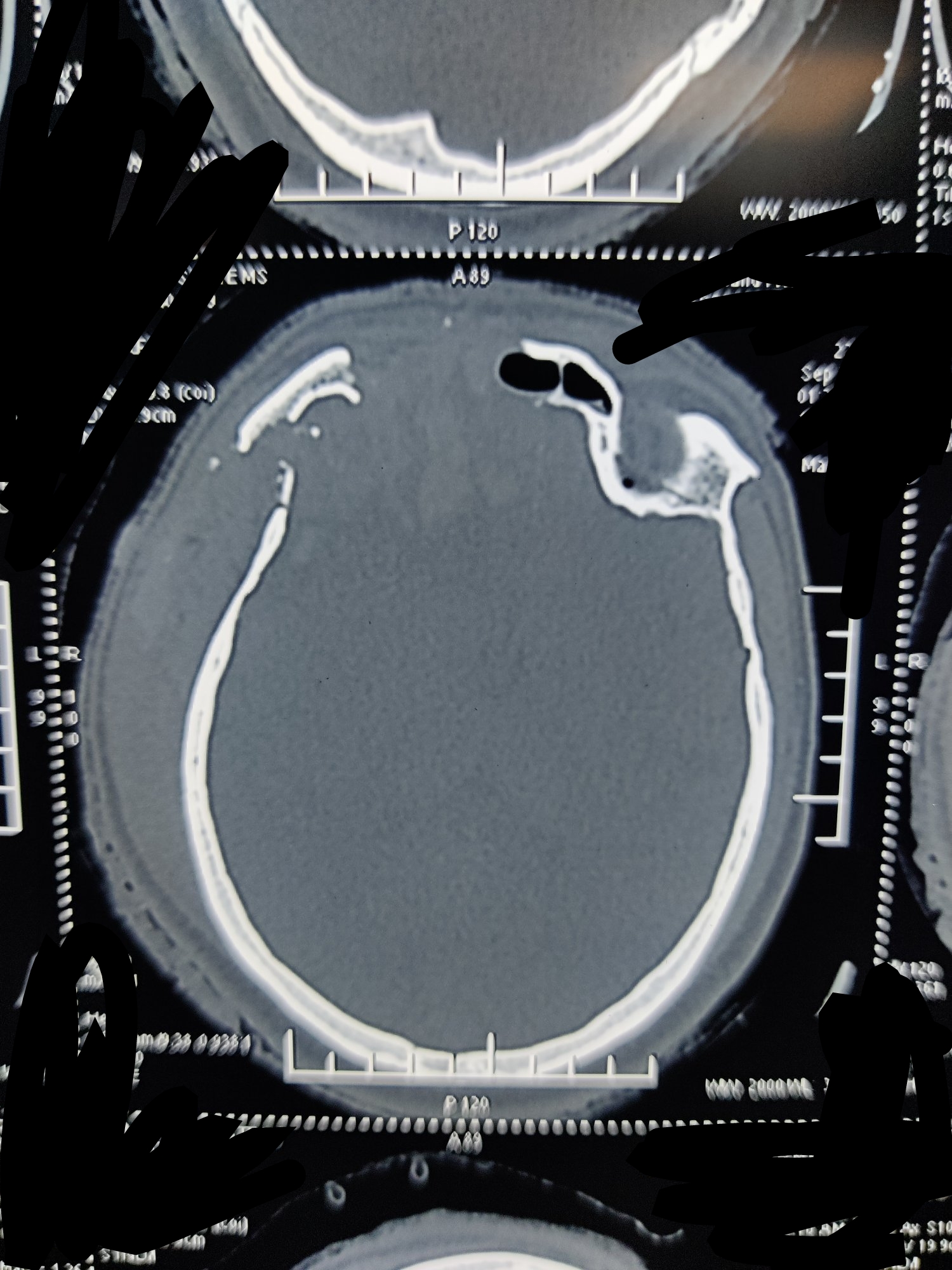 POLYTRAUMA WITH SEVERE TRAUMATIC BRAIN INJURY.