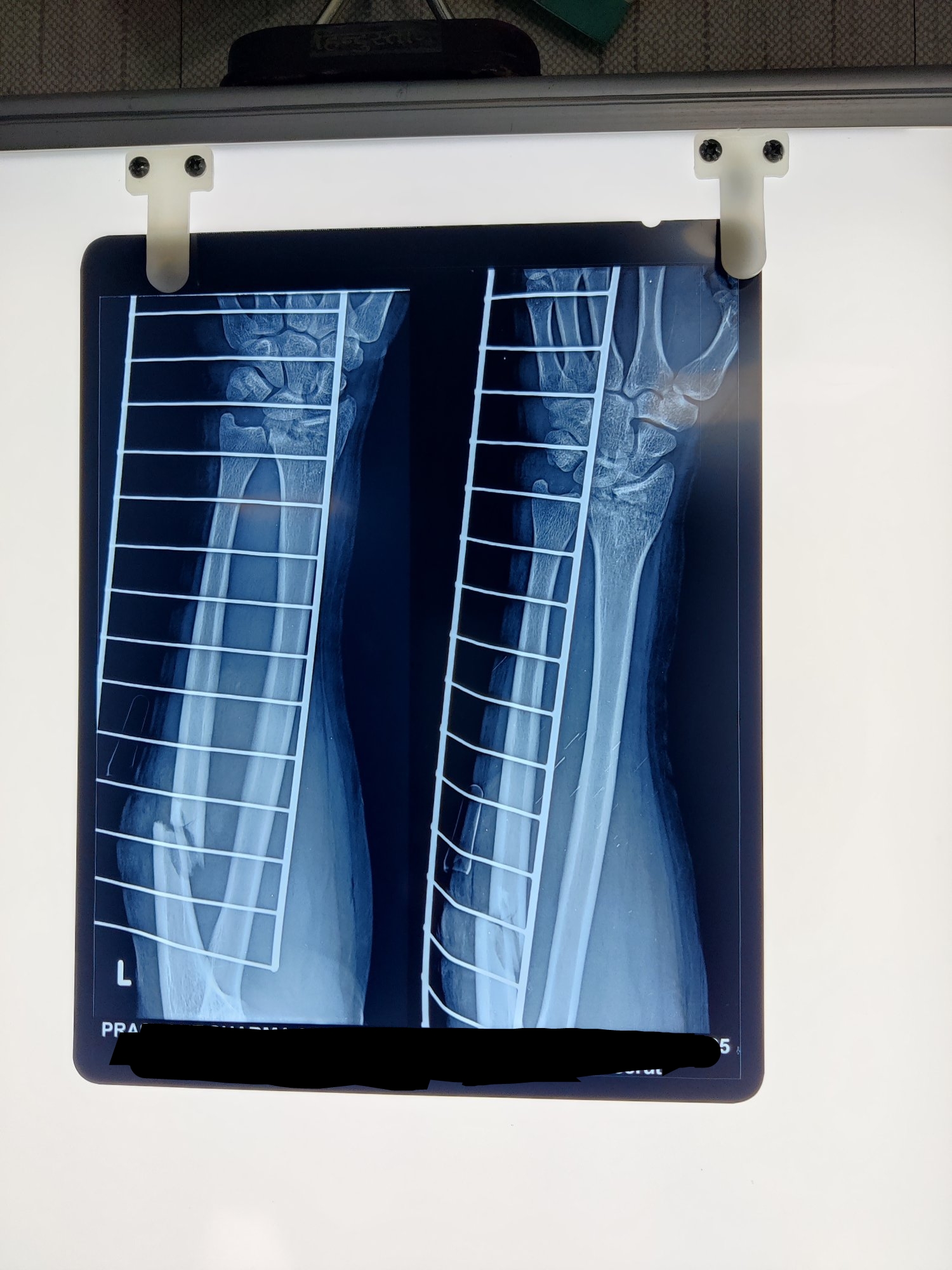 POLYTRAUMA WITH SEVERE TRAUMATIC BRAIN INJURY.